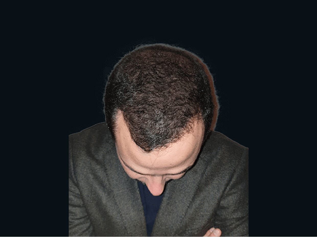 Tiña del cuero cabelludo (tinea capitis): síntomas y tratamiento